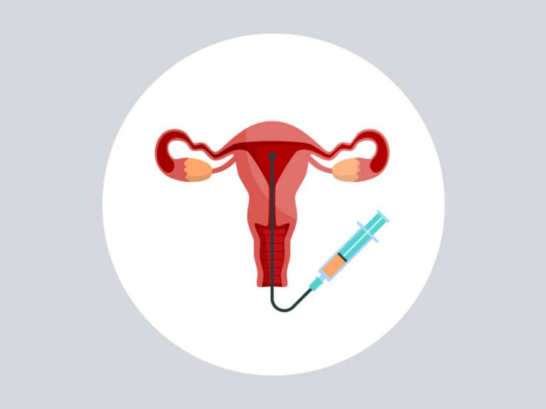 IUI Treatment – Safe & Effective Fertility Solution